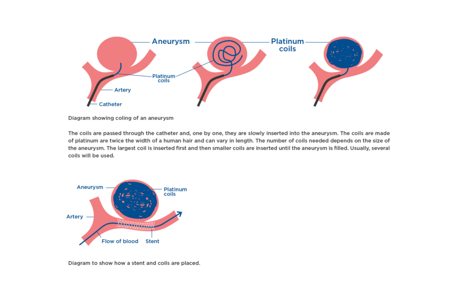 Brain Aneurysm: Symptoms, Recognition, and Treatment