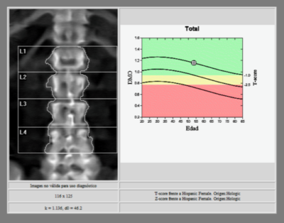 Densitometría Ósea, nueva prueba diagnóstica en Hospital CMQ
