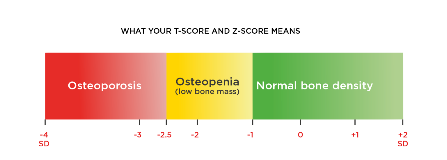 Dexa Scan New Diagnostic Test Available At Hospital Cmq