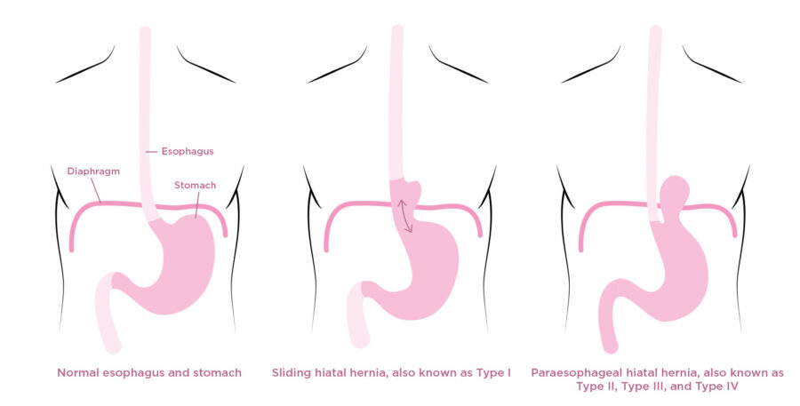 Hiatal Hernia 101: A Beginner's Guide From Our Experts