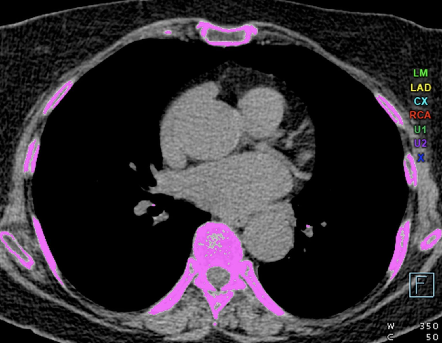 Coronary Calcium Scan: Detection and Prevention at Hospital CMQ