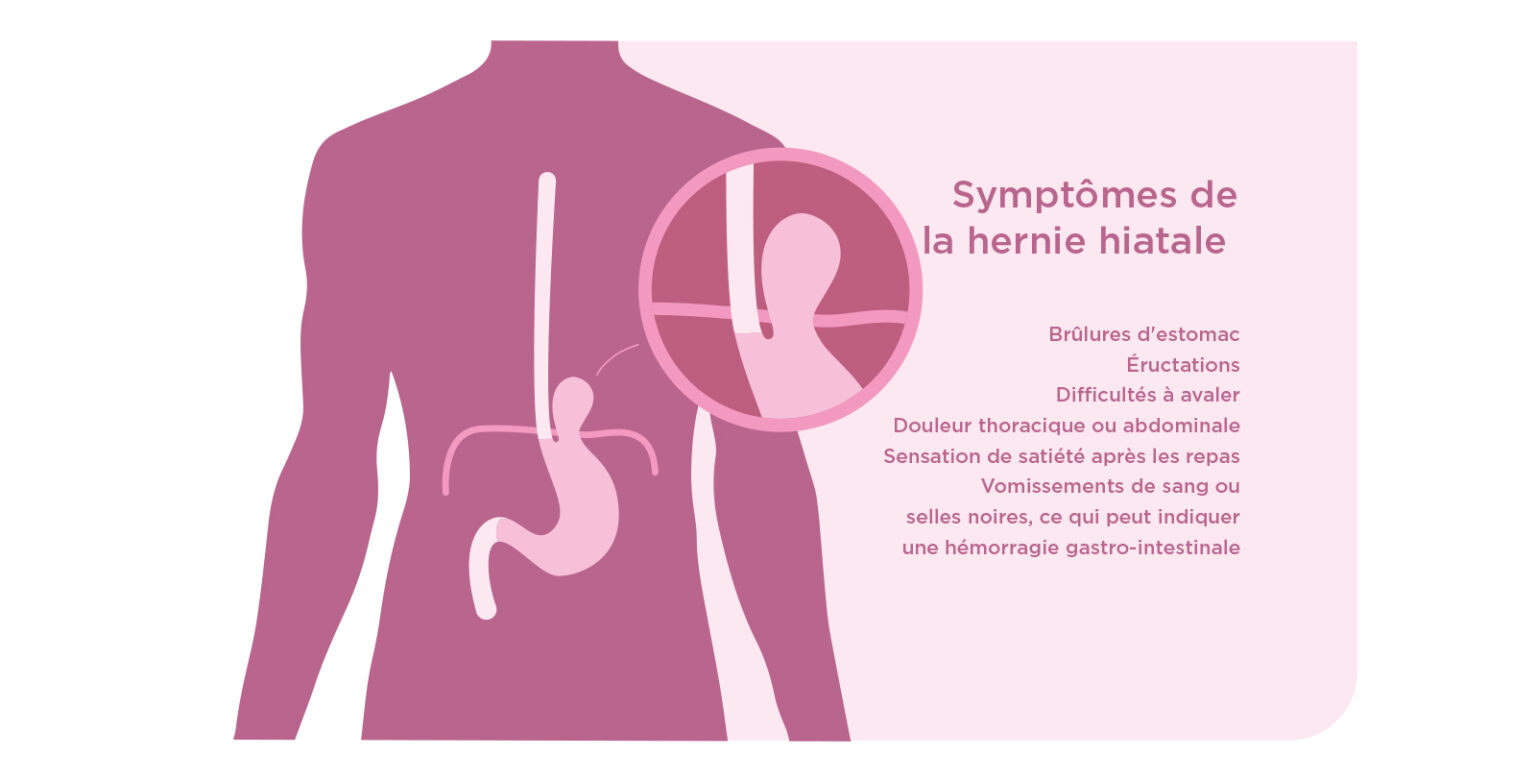 Hernie hiatale : Traitement d'excellence à l'hôpital CMQ
