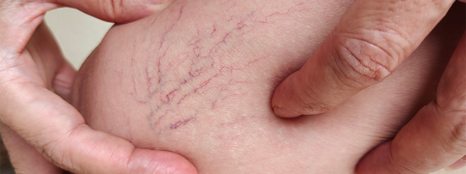 Trombosis Venosa Profunda: Diagnóstico y Tratamiento en Hospital CMQ