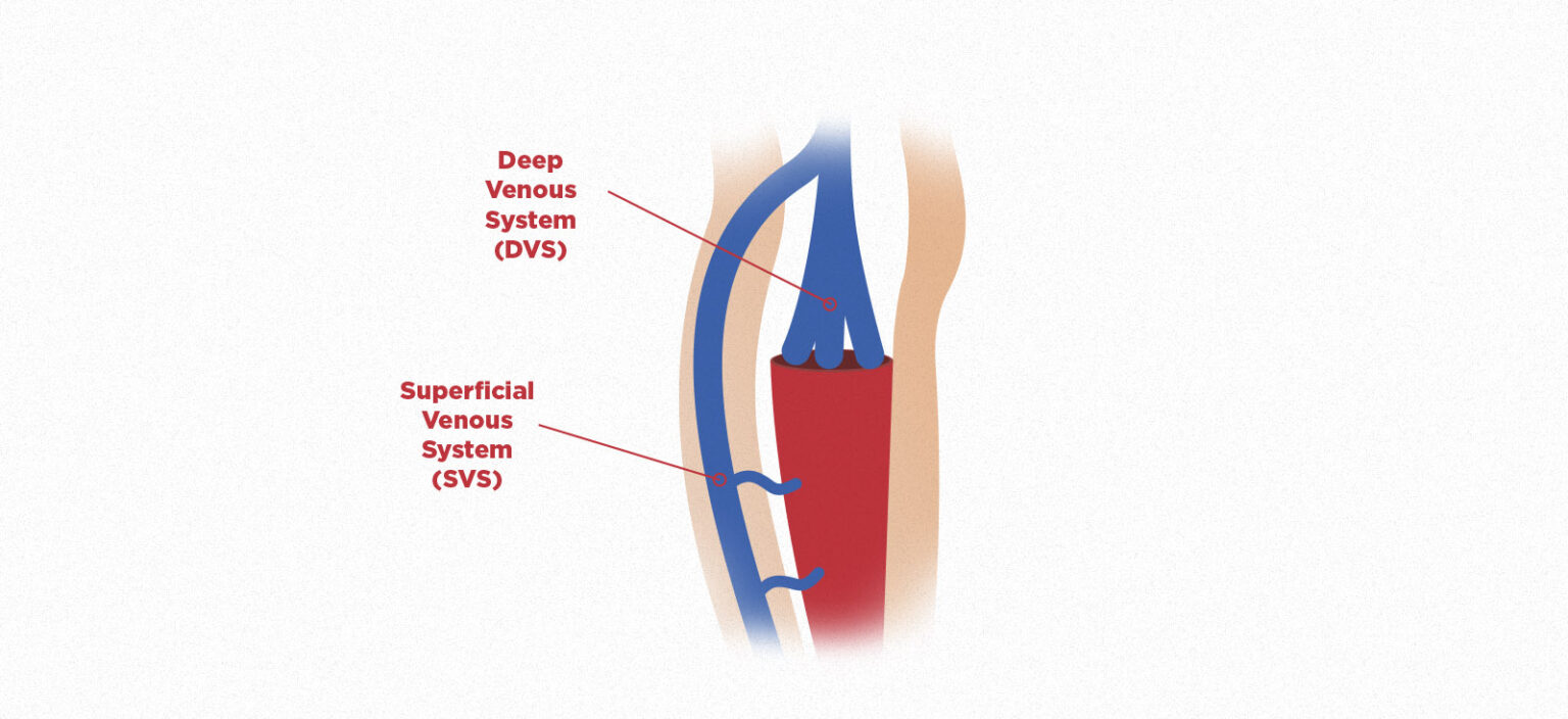 Deep Vein Thrombosis (DVT): Expert Care at Hospital CMQ