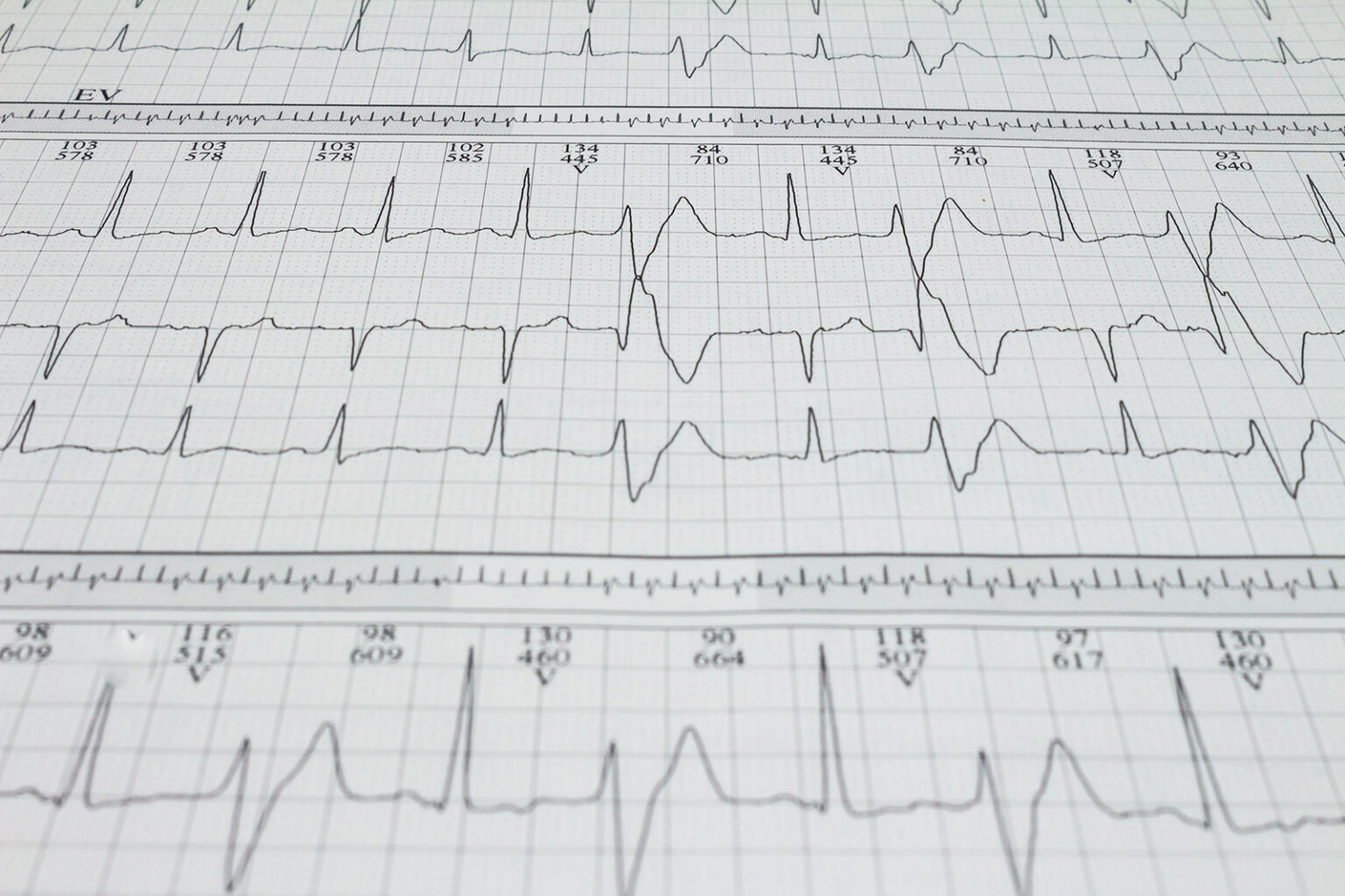 Holter Monitor: The 24-Hour Heart Test That Could Save Your Life