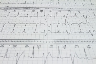 Holter Monitor: The 24-Hour Heart Test That Could Save Your Life