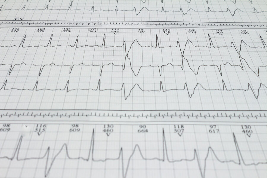 Holter Monitor: The 24-Hour Heart Test That Could Save Your Life