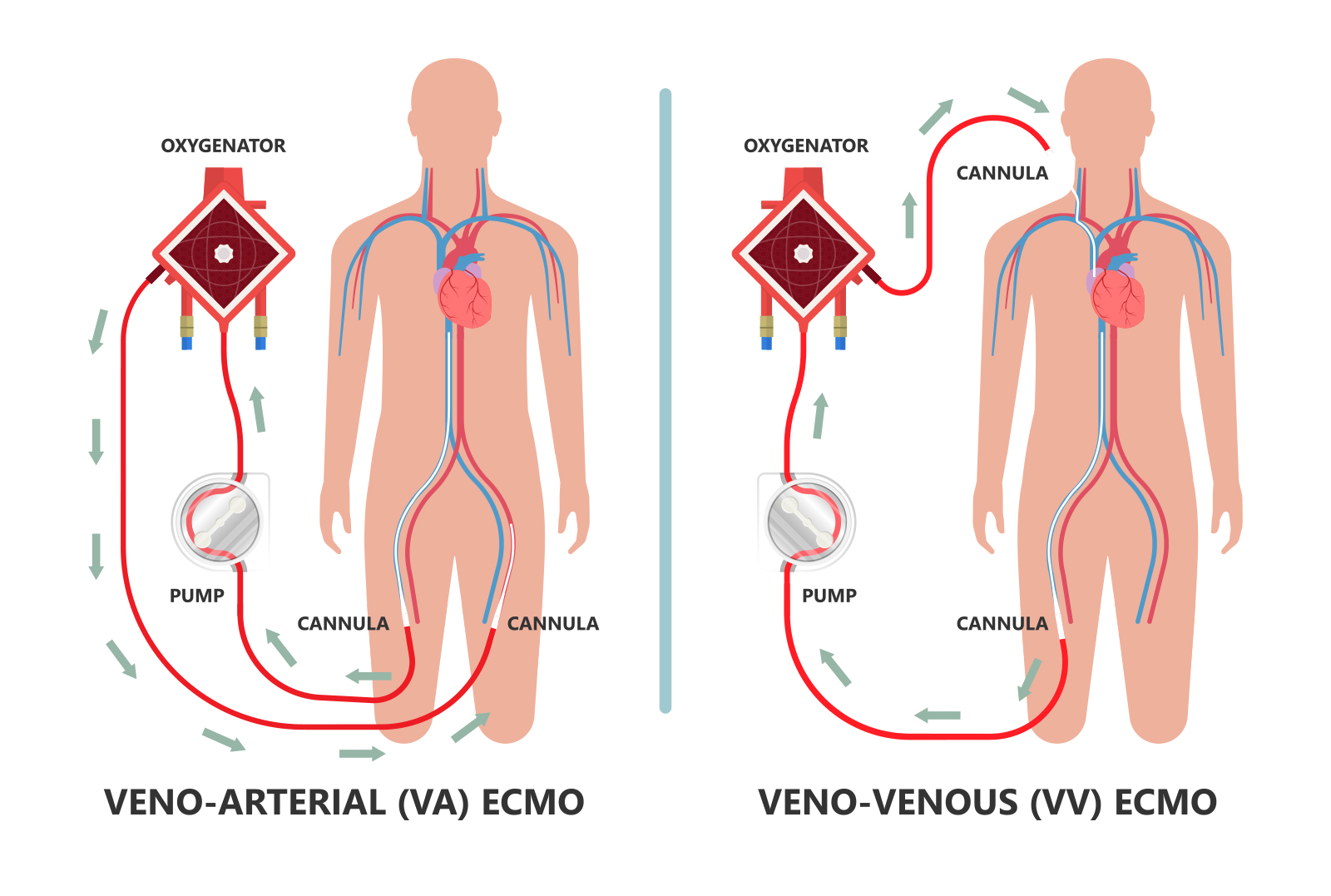 What Is Extracorporeal Membrane Oxygenation ECMO 